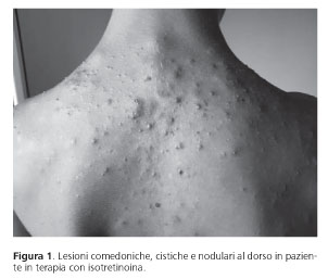 Isotretinoina in linea — Cassaforte online